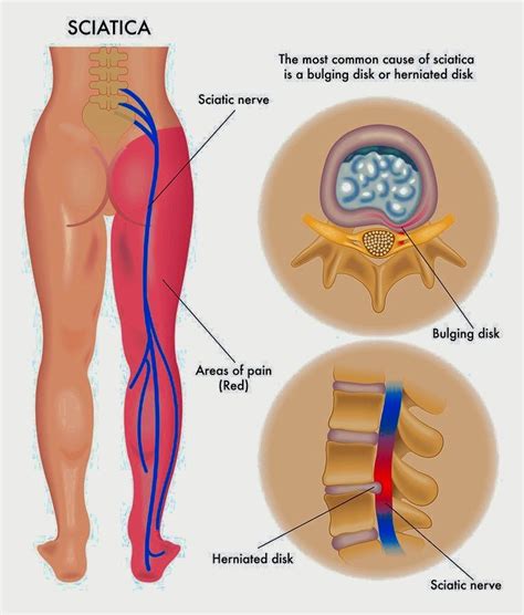 Sapna This Image Illustrates A Bulging Disc And Its Potential Impact On The Sciatic Nerve