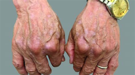 Dupixent® Dupilumab Results In 18 Years