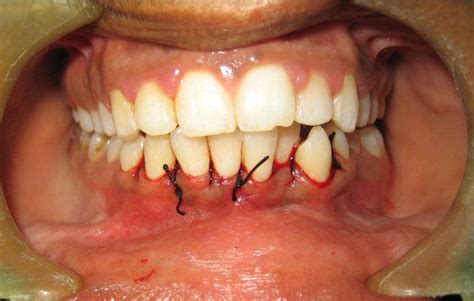 Gingivectomy Fms Dental Hospital