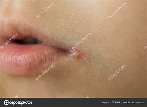 Skin Problems Angulitis Angular Stomatitis Angular Cheilitis A