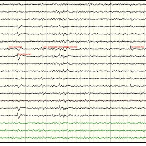 Scalp Eeg Signal Showing A Hfo Pattern Over Left Fronto Temporal Areas Download Scientific