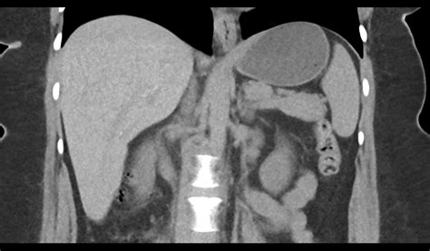 Choledochojejunostomy Image