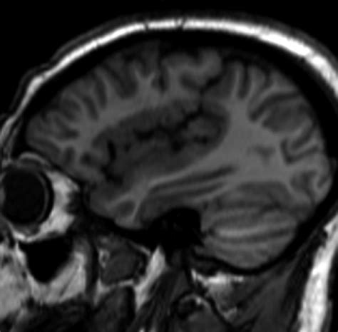 Perisylvian Polymicrogyria Imaging At 3 Tesla Displays An Operculum