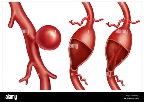 Schematic Illustration Of Types Of Aneurysms It Is The Widening Of An Artery The Types Of