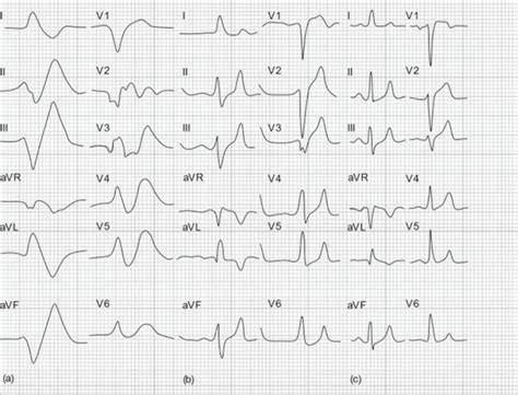 Topic Hyperkalemia 12 Lead Ecg Certification Course Acls