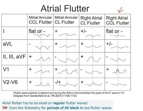 How Ai Sharpens Ecg Diagnosis For Atrial Flutter Zain Khalpey Md