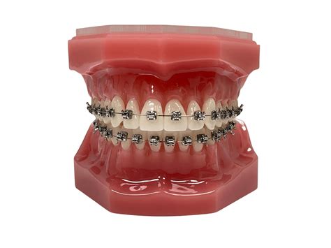 Hybrid Orthodontic Treatment - Boss Orthodontics