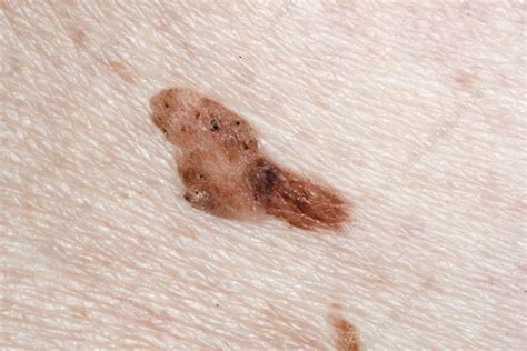 Seborrheic Keratosis Stock Image C058 1246 Science Photo Library