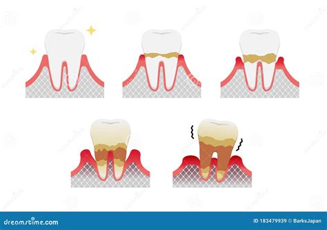 The Stages Of Periodontitis Disease Illustration Moderate
