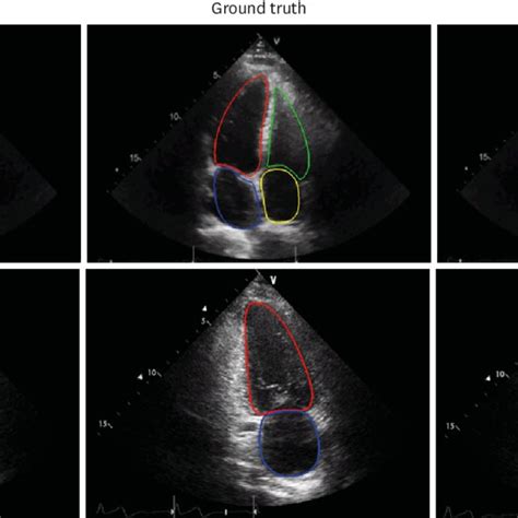 Examples Of Endocardial Border Detection Artificial Intelligence