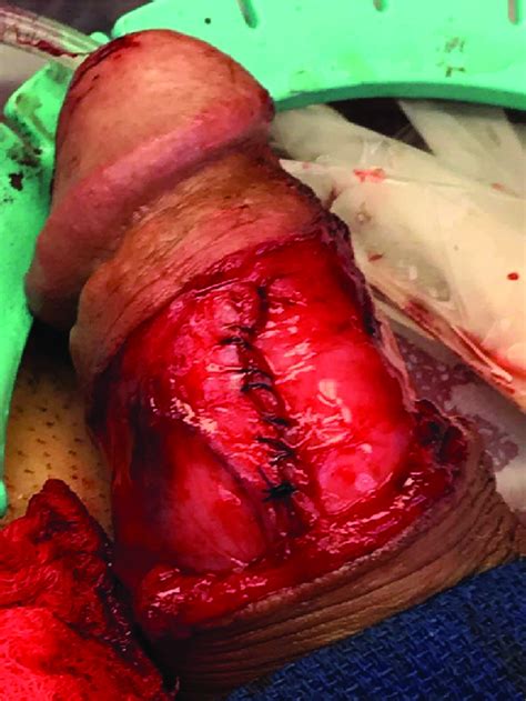 Tunica And Pseudocapsule Closed With The Device Inflated And No Obvious Download Scientific