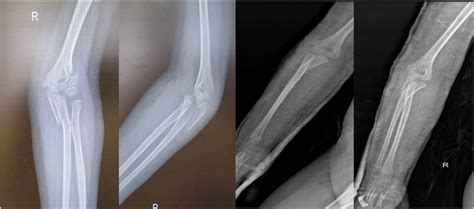 Radiographs Of The Right Elbow A B Proximal Ulnar Fracture And Download Scientific Diagram