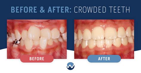 Ways We Can Help With Teeth Crowding Woodhill Dental Specialties