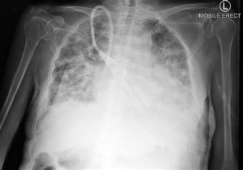 Noncardiogenic Pulmonary Edema Cxr