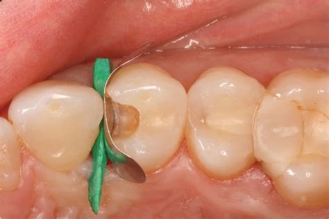 Figure 4 From Class Ii Composite Restorations And Proximal Concavities