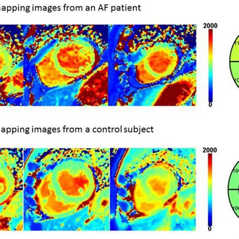 Native T 1 Mapping Images From A 62 Year Old Male Atrial Fibrillation Download Scientific