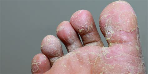 What Is The Best Treatment For Fungal Infection Postmymeds