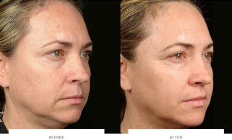 How To Get Rid Of Jowls Jowls Face Treatment London Buckinghamshire