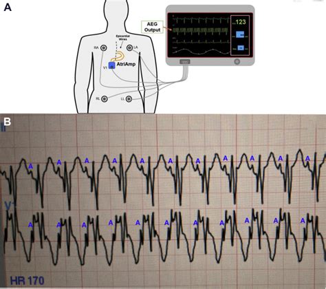 First In Human Use Of A Continuous Real Time Atrial Electrogram Monitoring Device After Cardiac