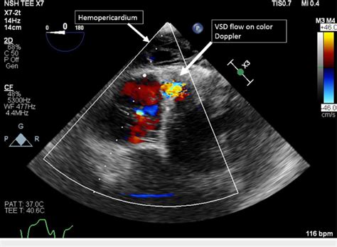 Transesophageal Echocardiography Tee Image Of Hemopericardium Vsd Download Scientific