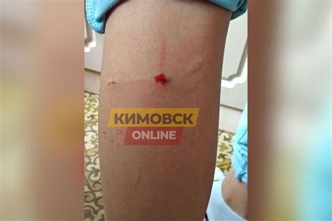 В Тульской области бездомная собака напала на 14 летнюю девочку Газета Ru Новости