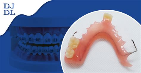 Removable Partial Denture Vs Flipper At Stephaine Marvin Blog
