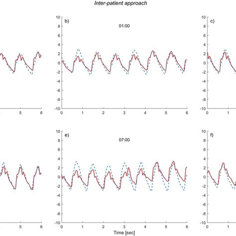 The Non Invasive Icp Waveform Estimated From The Intra Patient Approach Download Scientific