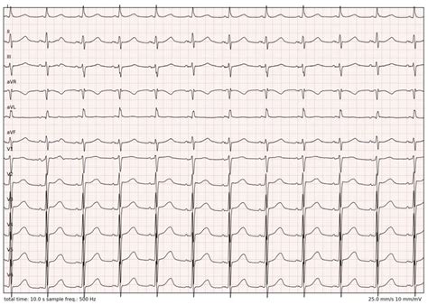 Figure S4 Example Of A Full 12 Lead Electrocardiogram Ecg Download Scientific Diagram