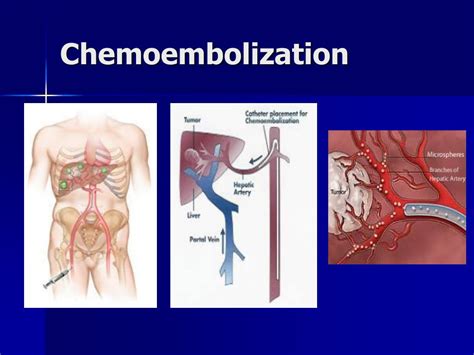 Ppt Interventional Oncology Powerpoint Presentation Free Download Id 5386195