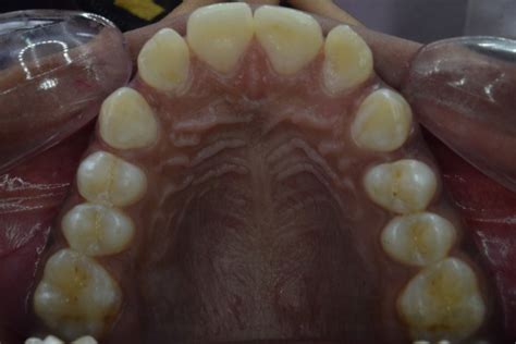 Dentalproject4 Object Detection Dataset And Pre Trained Model By Dental