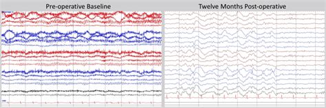 EEG At Baseline And One Year Post Operatively At Baseline The EEG Download Scientific Diagram