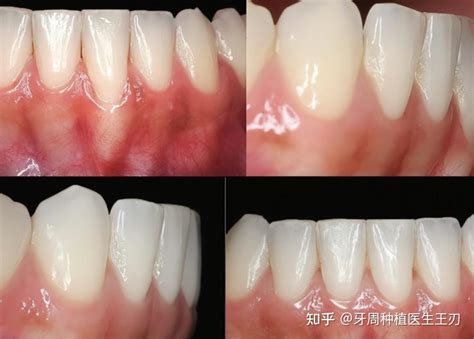 正畸治疗会导致牙龈萎缩吗？ 知乎