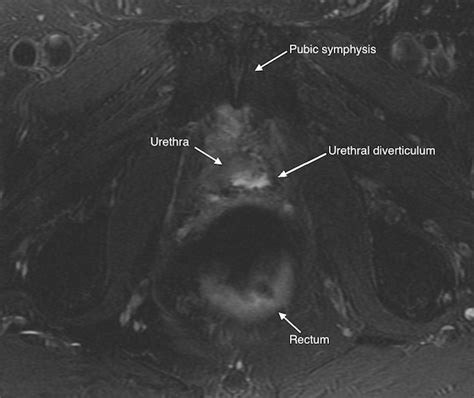Urethral Diverticulum Mri Epos™