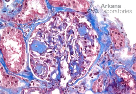 Nodular Glomerulosclerosis Trichrome Ismms Nephrology Fellowship