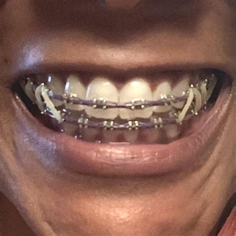 Triangle Elastics Galore R Braces