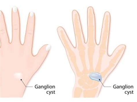 Ganglion Cyst Aspiration Success Rate
