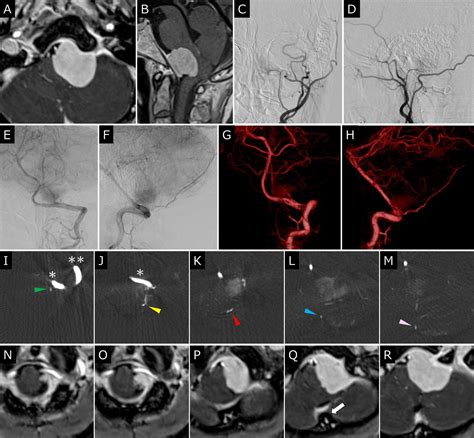 Preservation Of The Posterior Meningeal Artery During Excision Of A
