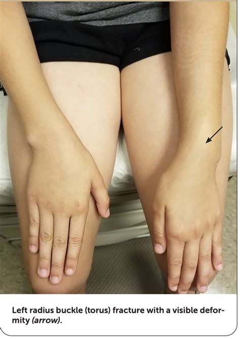 Buckle Fracture Wrist Splint Buckle Fracture Wrist Splint
