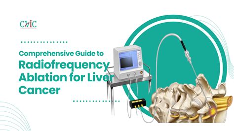Comprehensive Guide To Radiofrequency Ablation For Liver Cancer