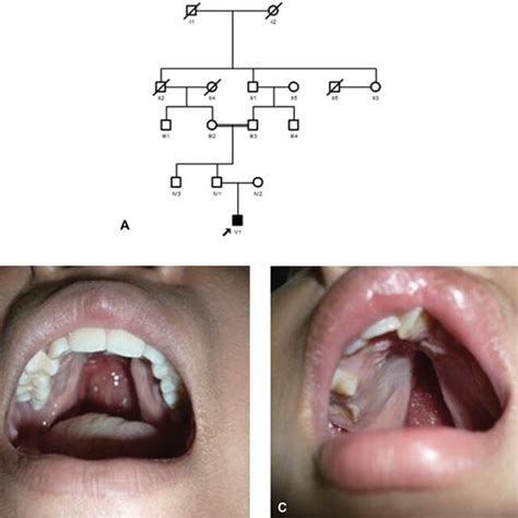 Type Of Consanguinity Of Patients With Ns Cl P Download Scientific Diagram