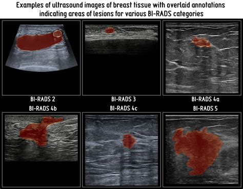 Breast Lesions Usg The Cancer Imaging Archive Tcia