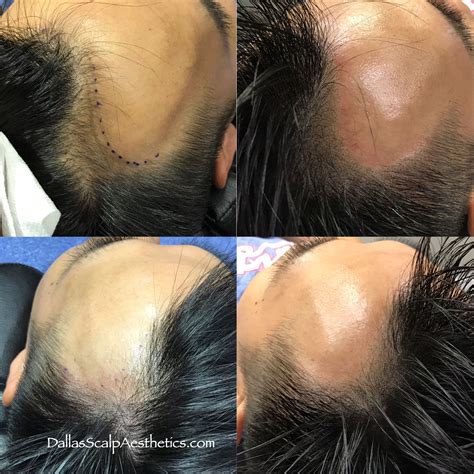 Scalp Pigmentation 2 Dallas Scalp Associates