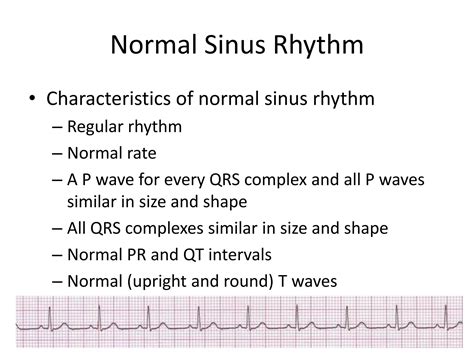 Normal Sinus Rhythm Pptx