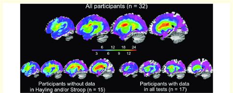 Overlap Maps Of The Patients Lesions The Slices Correspond To Mni