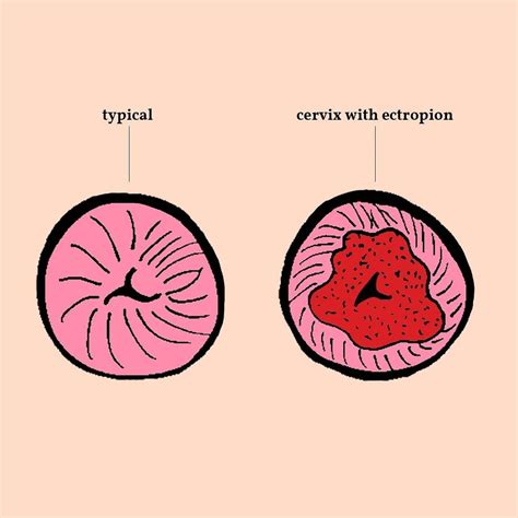 Female Anatomy Cervical Ectropion Body Cervix Female Anatomy