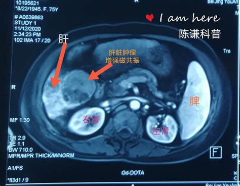 肝硬化肝癌诊治病例分享 京东健康