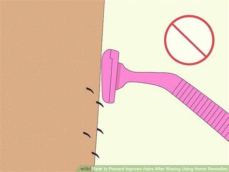 11 Simple Ways To Prevent Ingrown Hairs After Waxing Using Home Remedies