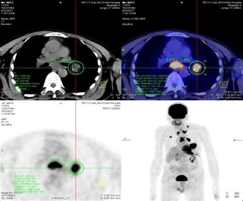 Correlation Between Suvmax And Overall Stage R 0 060 P 0 725 Download Scientific Diagram