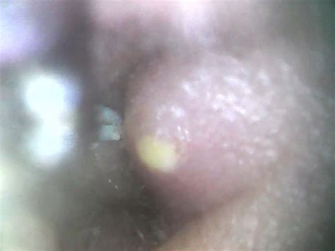 Ear Canal Abscess Popping Aftermath In The End Rpopping