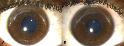 Terriens Marginal Degeneration Ring Shaped Corneoscleral Lamellar
